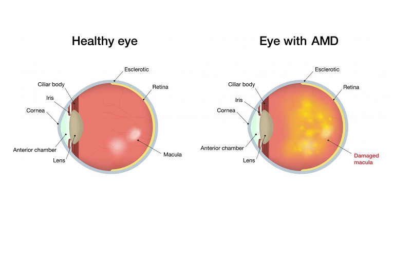Common Eye Diseases in Patients – Care Group Global