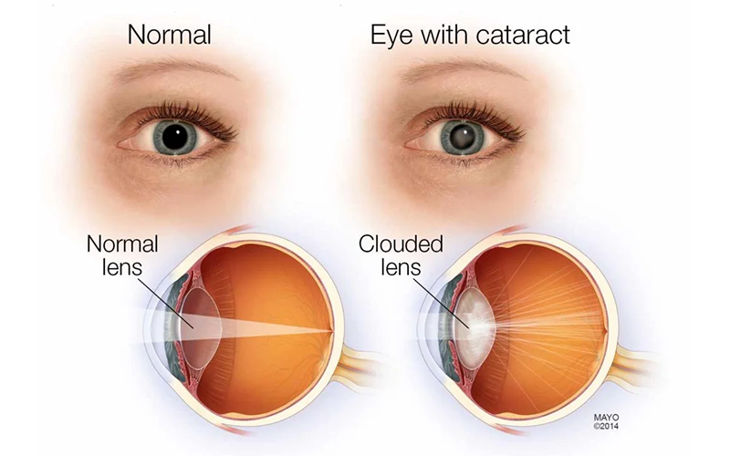 Common Eye Diseases in Patients – Care Group Global